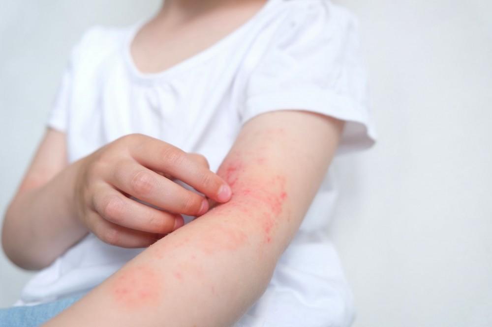 The Untold Facts about Atopic Dermatitis: Unraveling its Causes and ...